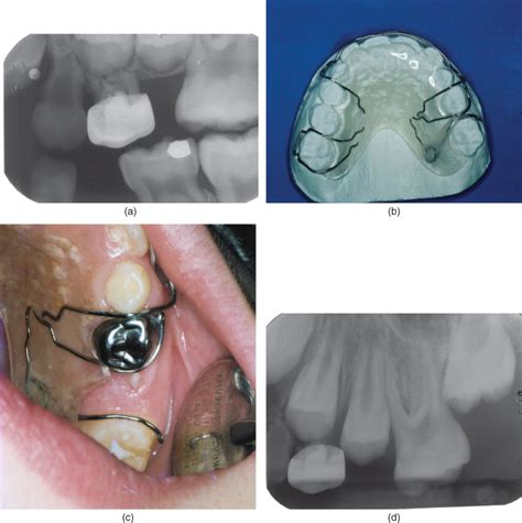 Ectopic Eruption Of Maxillary First Permanent Molar Pocket Dentistry