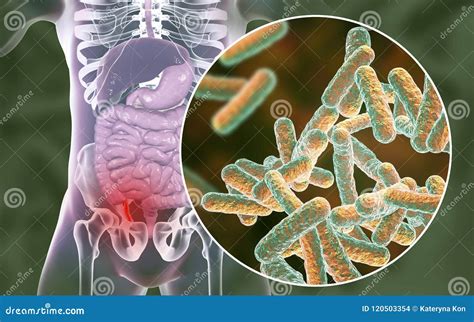 Acute Appendicitis Illustration Stock Illustration Illustration Of Biology Body 120503354