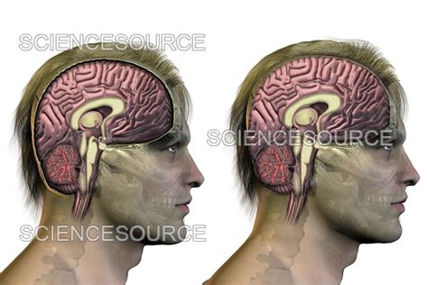 Normal Brain Vs Hyponatremia Stock Image Science Source Images