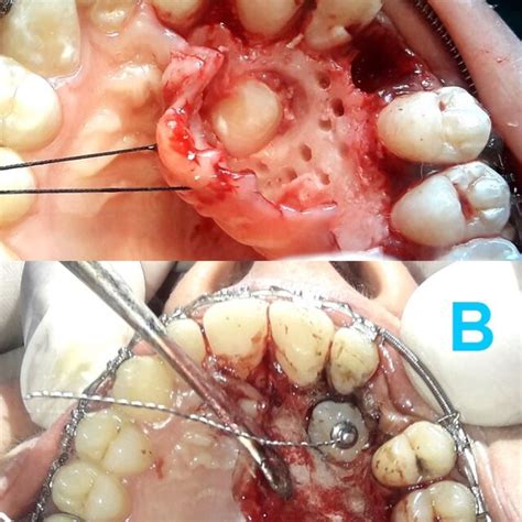 The Corticotomy Procedures A The First Corticotomy Procedure Download Scientific Diagram