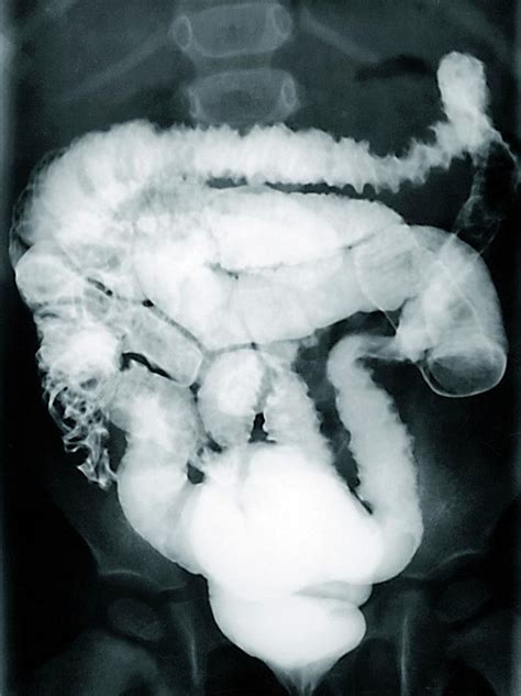 Intussusception Of The Intestines 5 Photograph By Zephyr Fine Art America