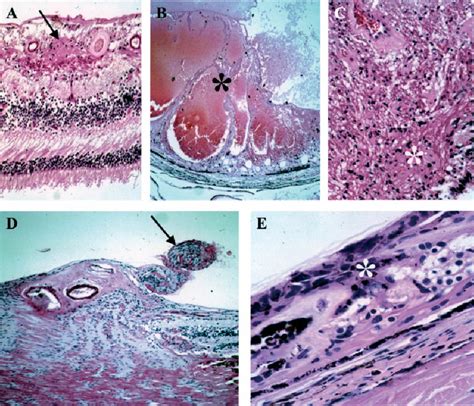 Retinal Hamartomas A A Small Vascular Hamartoma Arrow Located In