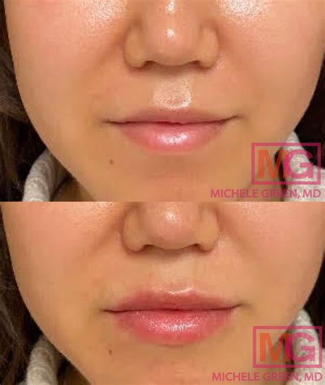 How To Get Rid Of White Spots On Lips After Filler
