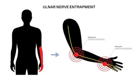 Premium Vector Ulnar Nerve Entrapment