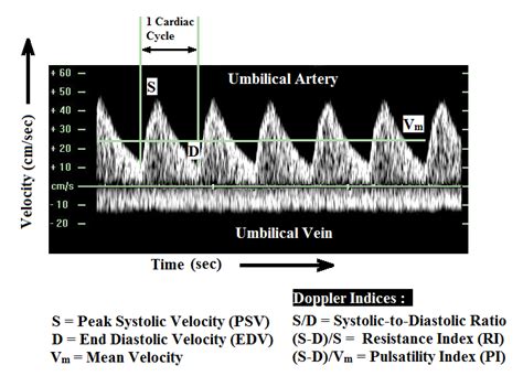 Doppler Velocimetry Of Umbilical Artery And Doppler Indices Download