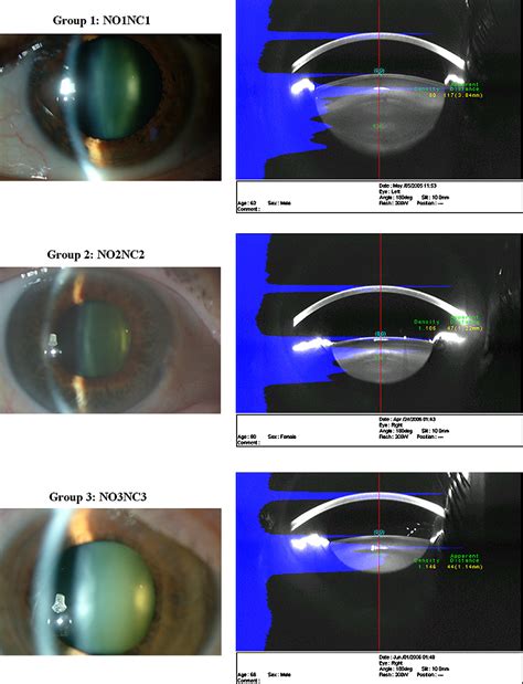 Figure 1 From Grading Nuclear Cataract Opacity By Densitometry And
