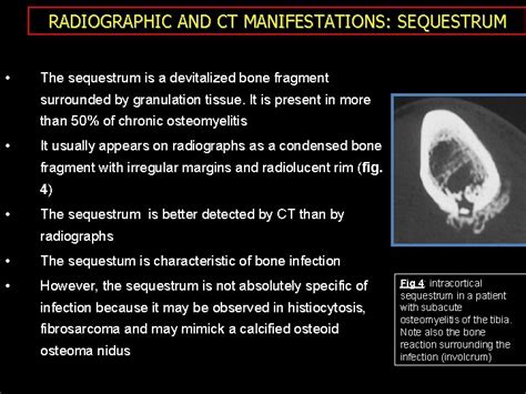 Bone Infection Mimicking Bone Tumors How To Make