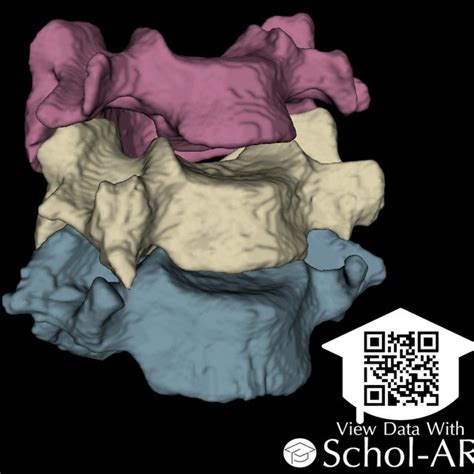Accessory Articulation Of The Transverse Processes At C6 C7 Axial Download Scientific Diagram