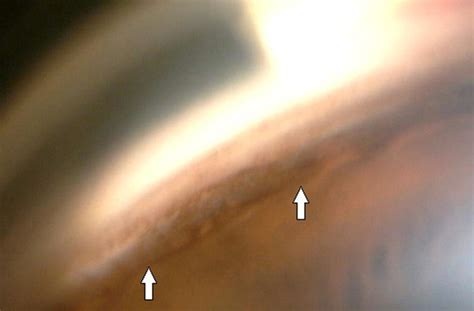 Grade 4 Open Angle In Shaffers Grading With Increased Pigmentation And