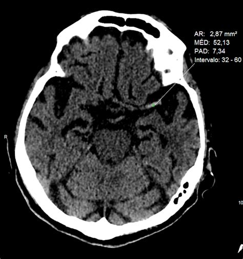 Radiological CT Findings And Time Evolution In Acute Stroke Case Report MedCrave Online