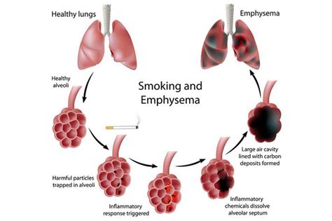 Diseases Caused By Smoking Nexus Newsfeed