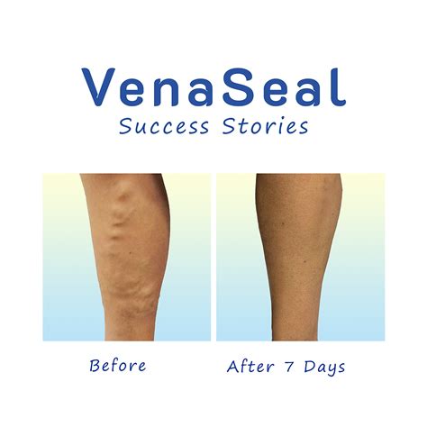 Varicose Glue Treatment The Vein Center