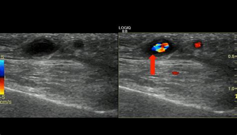 Temporal Artery Ultrasound Cranial Arteritis Temporal Arteritis