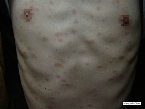 장미색 비강진장미색잔비늘증 Pityriasis Rosea 네이버 블로그