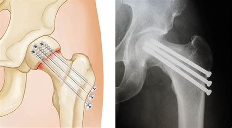 Hip Fractures Orthoinfo Aaos