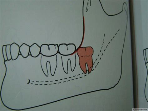 Impaction Pptx Drfidaa Muhadharaty
