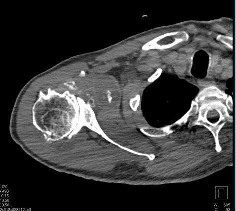Glenohumeral Joint Effusion Shoulder