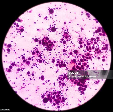 악성 세포 폐의 흉막 액체 세포학 전이성 선암 분석 보기에 대한 스톡 사진 및 기타 이미지 분석 보기 암세포 폐암 Istock