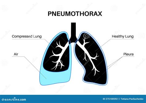 Pneumothorax Anatomical Poster Vector Illustration