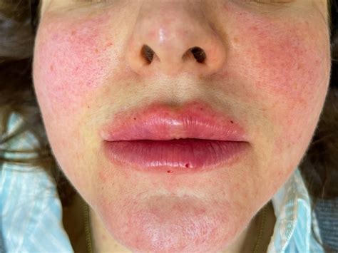 Premium Photo Lip Augmentation Procedure Of A Beautiful Woman In A Beauty Salon Puncture Marks