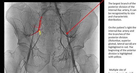 The Pump And The Tubes Internal Iliac Artery Posterior Division Superior Gluteal Artery
