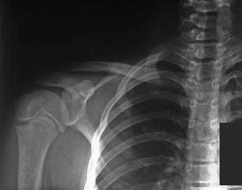 Normal Humerus X Ray Growth Plates