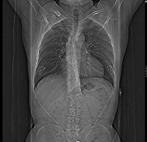 82011 Visualized Lungs Demonstrate Mild Centrilobular Emphysema