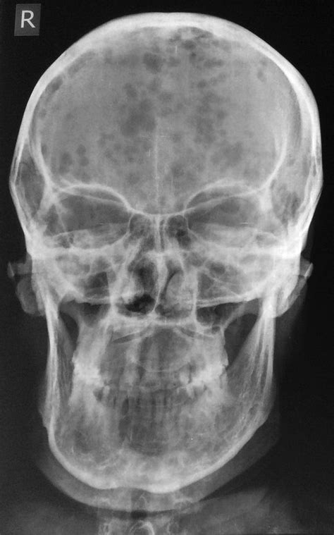 Multiple Myeloma Radiology Case Radiology Multiple Myeloma Radiology Case Radiology