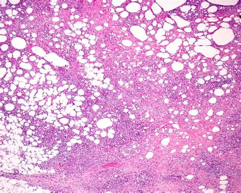 Breast Fat Necrosis Light Micrograph Stock Image C0510126 Science Photo Library