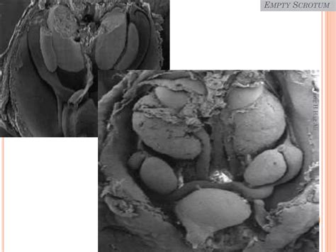 Empty Scrotum Tutorial Ppt