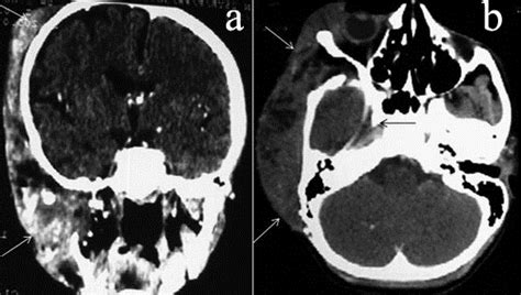 Neurofibromatosis Type 1 Plexiform Neurofibroma With Sphenoid Wing