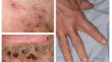 Monkeypox In Florida Is Your Rash Monkeypox Shingles Or Chickenpox