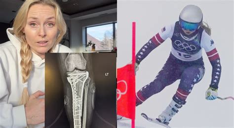 Lindsey Vonn Reveals How Torn Acl May Have Actually Saved Her Leg From Amputation