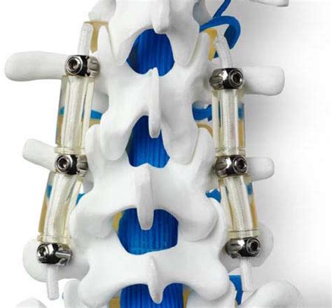 Spine Medical Devices