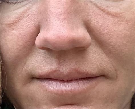 Hyperpigmentation On Perimeter Of Lips Rmelasmaskincare Hyperpigmentation On Perimeter Of Lips Rmelasmaskincare