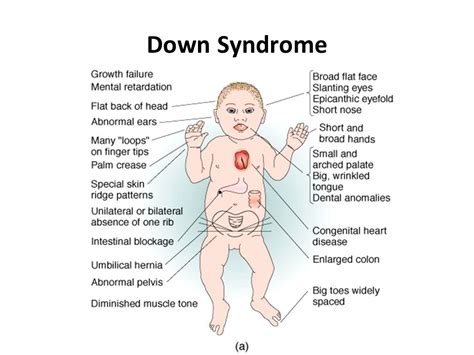 Infants With Down Syndrome Symptoms