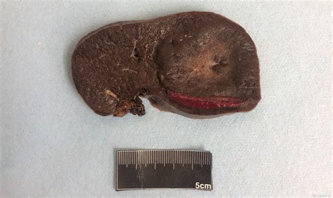 Spleen Ottawa Atlas Of Pathology