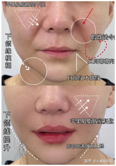 玻尿酸丰唇效果怎么样？ 嘴巴薄、不对称、下垂的唇部基础可以做吗？价格怎么样？ 知乎