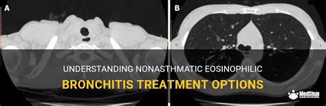 Understanding Nonasthmatic Eosinophilic Bronchitis Treatment Options Medshun