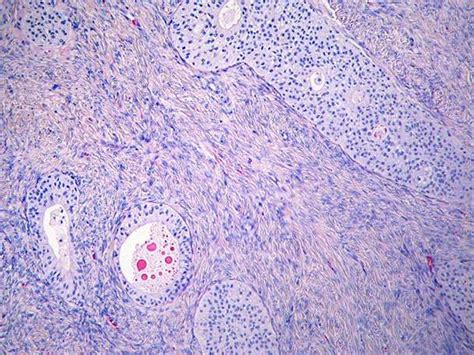 Benign Tumor Histology