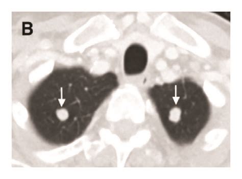 Axial Contrast Enhanced Computed Tomography Ct Scan Of Chest Showing