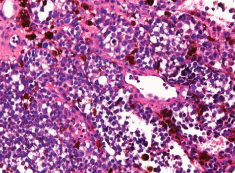 Histology Of The Conjunctival Tumor Malignant Epitheloid Cells Are
