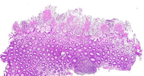 Eugene Marchukov On Linkedin A Good Example Of Pseudomembranous Colitis 60 Years Old Man Rectal…