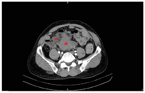 Computed Tomography Revealed Multiple Retroperitoneal Masses Red