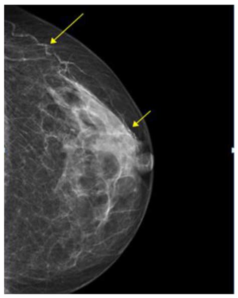 Breast Cancer Digital Mammogram