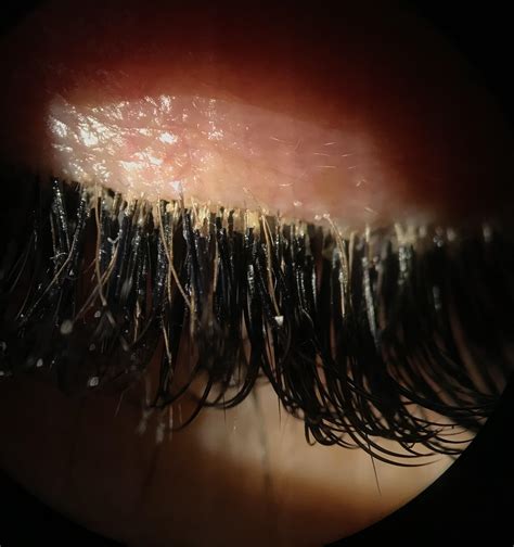 Eyelash Extensions And Blepharitis R Optometry