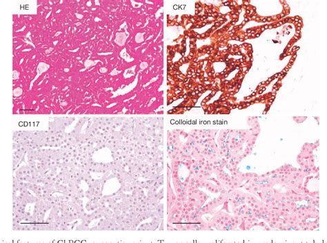 Figure From Classification Of Solid Renal Tumor With Oncocytic