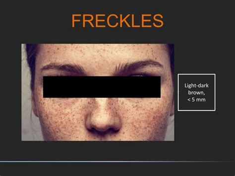 Overview Of Hyperpigmentation Disorders Pptx Skin And Dermatology