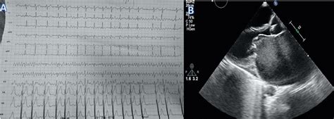 Himalayan Fibrillatory Waves In Juvenile Rheumatic Mitral Stenosis Indian Journal Of