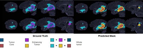 Figure 3 From Multiclass Tumor Segmentation From Brain Mris Using Garu Net Gelu Activated